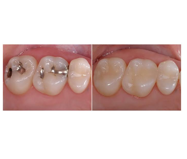Teeth Restoration / Fillings - NorthView Dental | Your London Dental Clinic